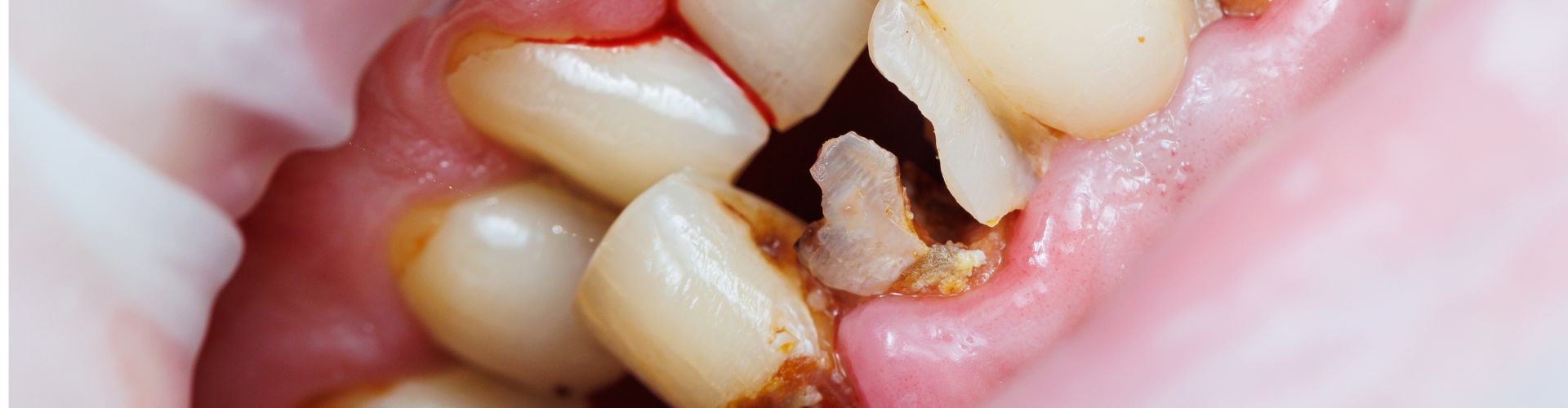 Rotten teeth: Causes, consequences and treatments