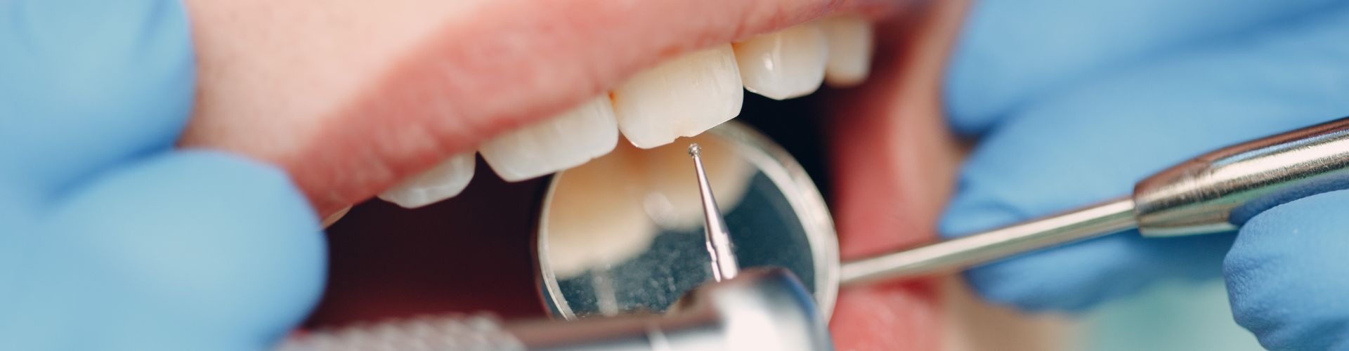 Discover the importance of dental prophylaxis with Gross Dentists