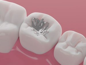 Peligros de la amalgama dental | Blog Gross Dentistas